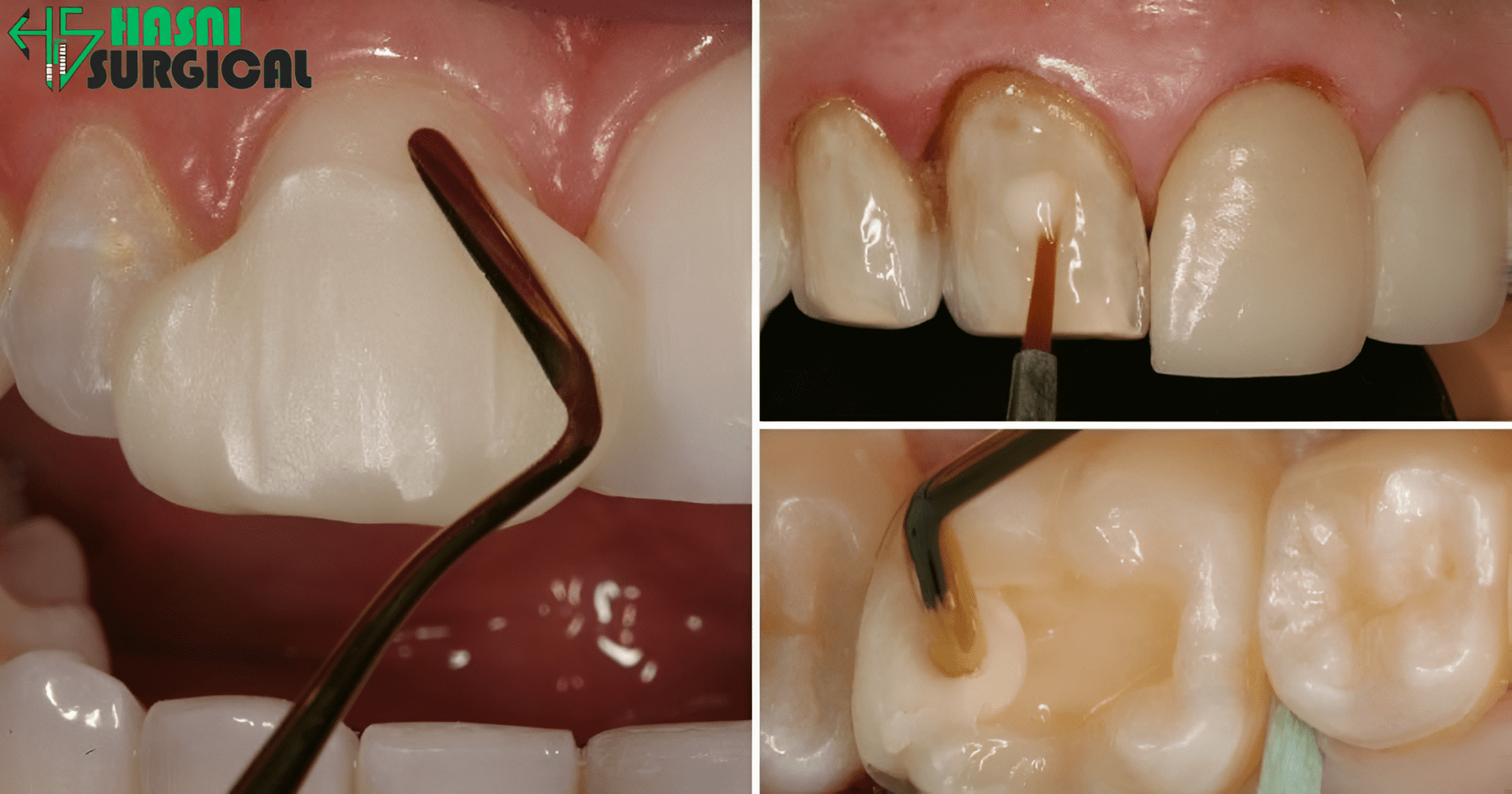 What Are Plastic Filling Instruments and their 5 most common types? An ...